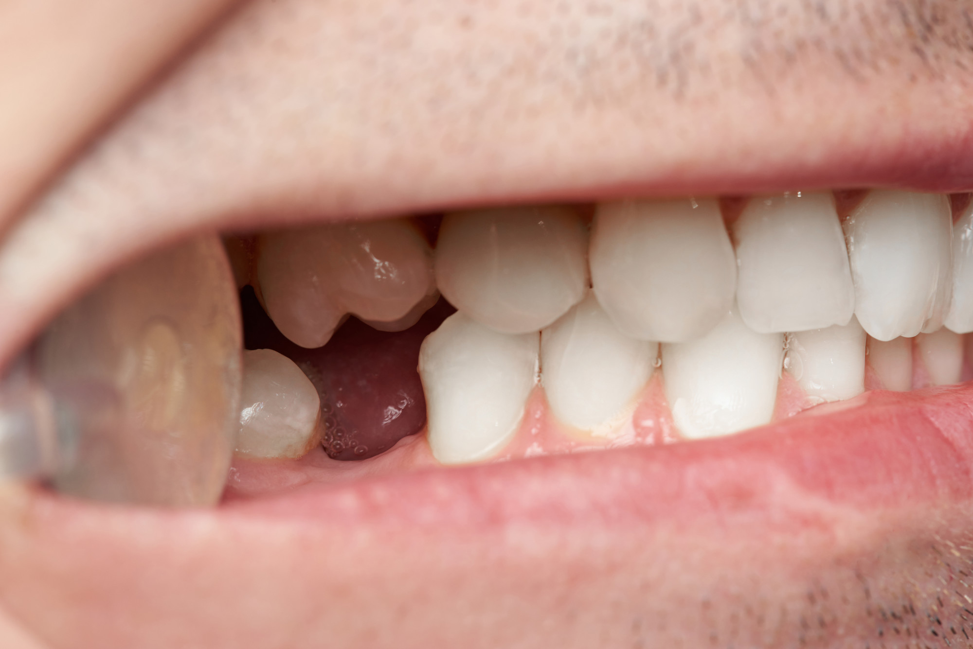 Top 5 Causes of Tooth Loss in Adults - Lives On